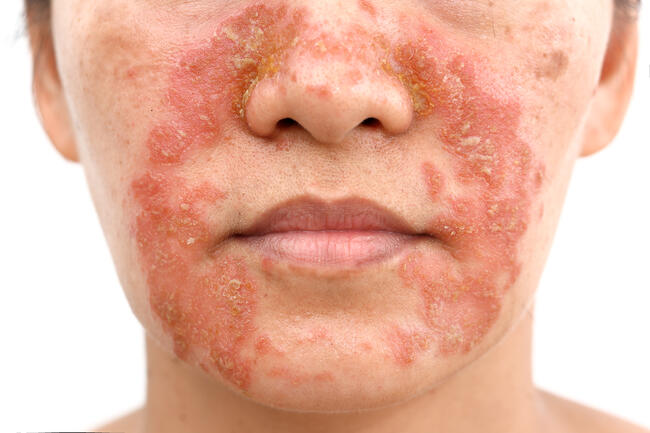 Treatment Efficacy in Atopic Dermatitis
