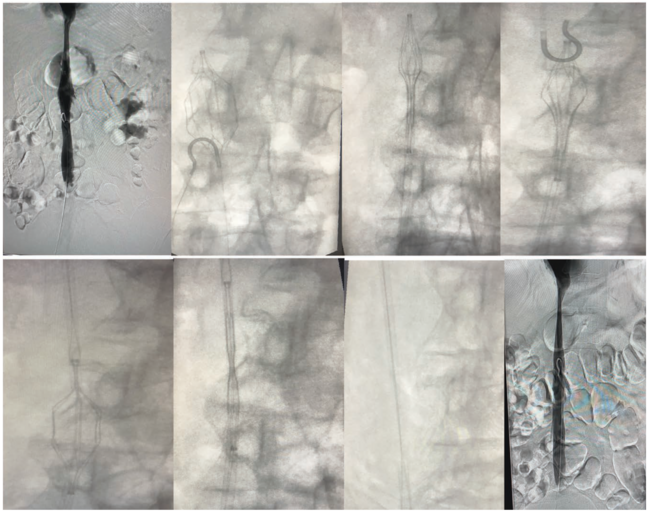 Complex TrapEase IVC Filter Retrieval Using Combined Telescoping Sheath ...
