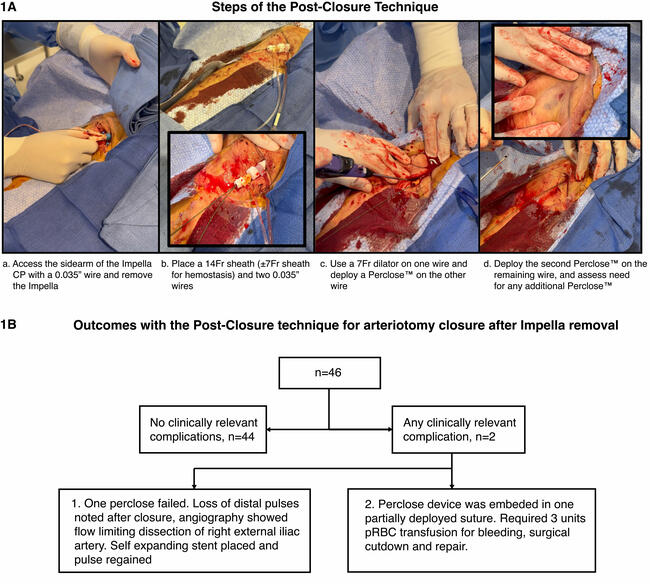 Clinical Outcomes of the Post-Closure Technique for Arteriotomy Closure ...