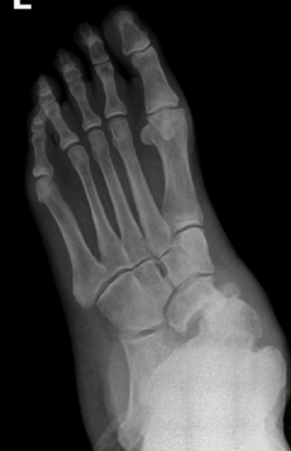 Test Your Knowledge: Progressive Collapsing Foot Deformity