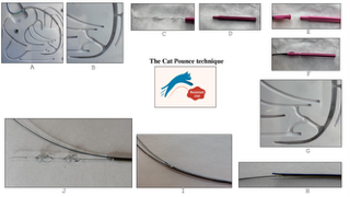 Coring Aspiration Thrombectomy or “CAT Pounce” Technique for Large ...