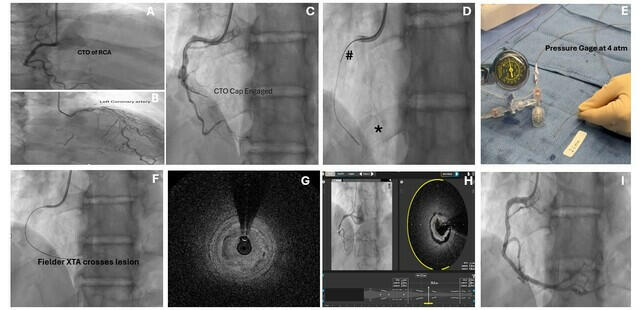 Potential Alternative Mechanism of HydroDynamic Contrast Recanalization ...